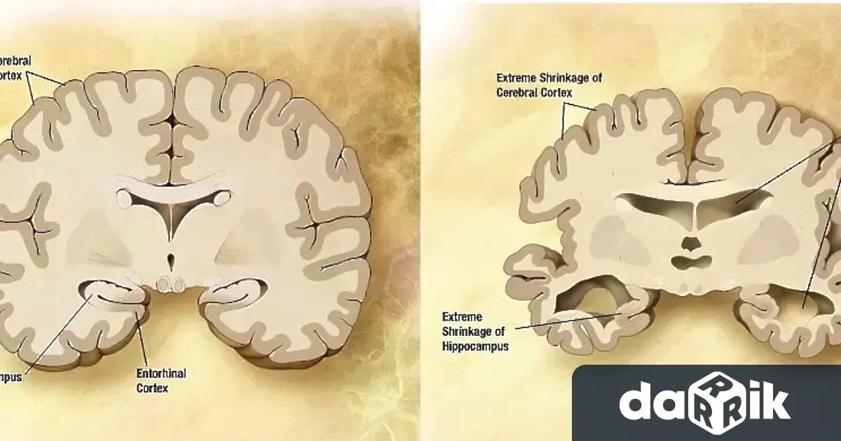Световен ден за борба с болеста на Алцхаймер - 21-ви септември | Darik.bg
